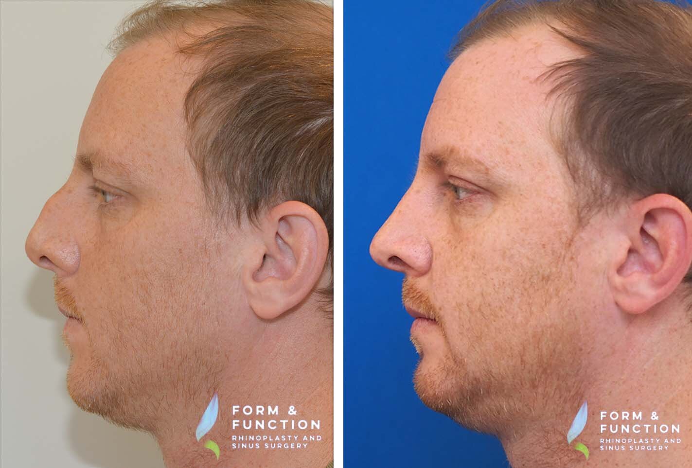 Male Rhinoplasty - Nose Job - Before and After Images - Form & Function