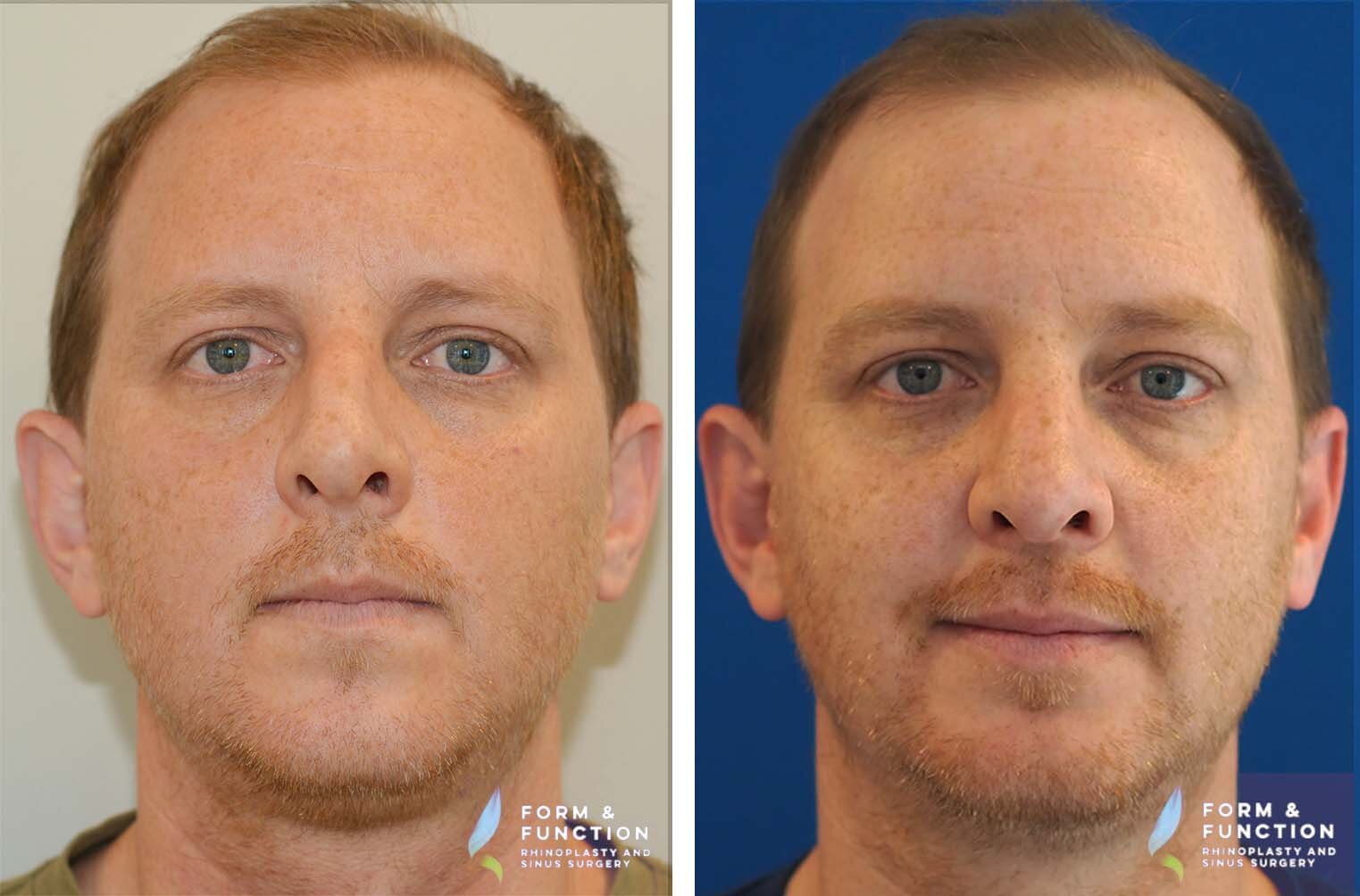 Male Rhinoplasty - Nose Job - Before and After Images - Form & Function